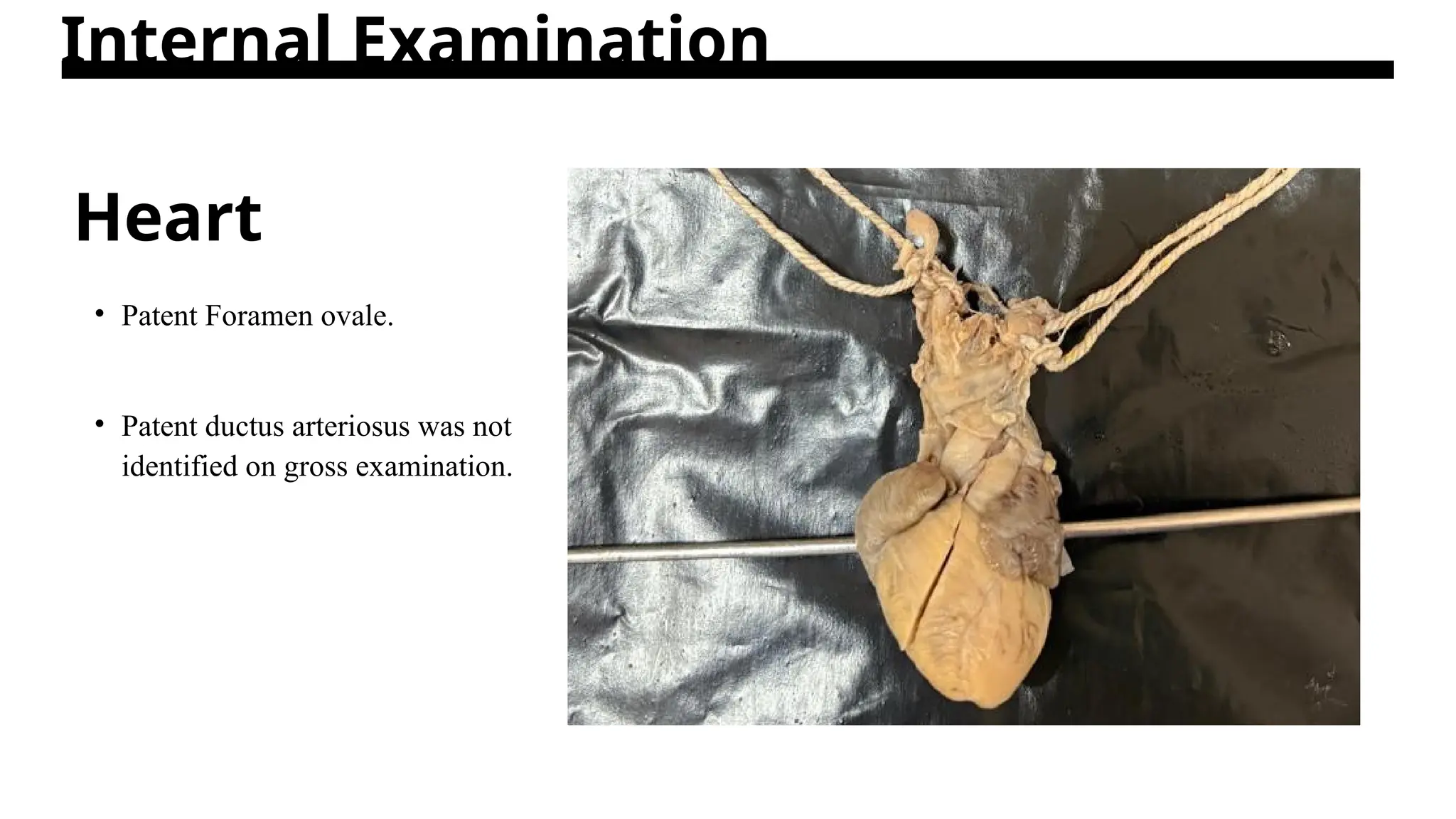 Comprehensive Fetal Autopsy in a Case of Prematurity with Patent Ductus ...
