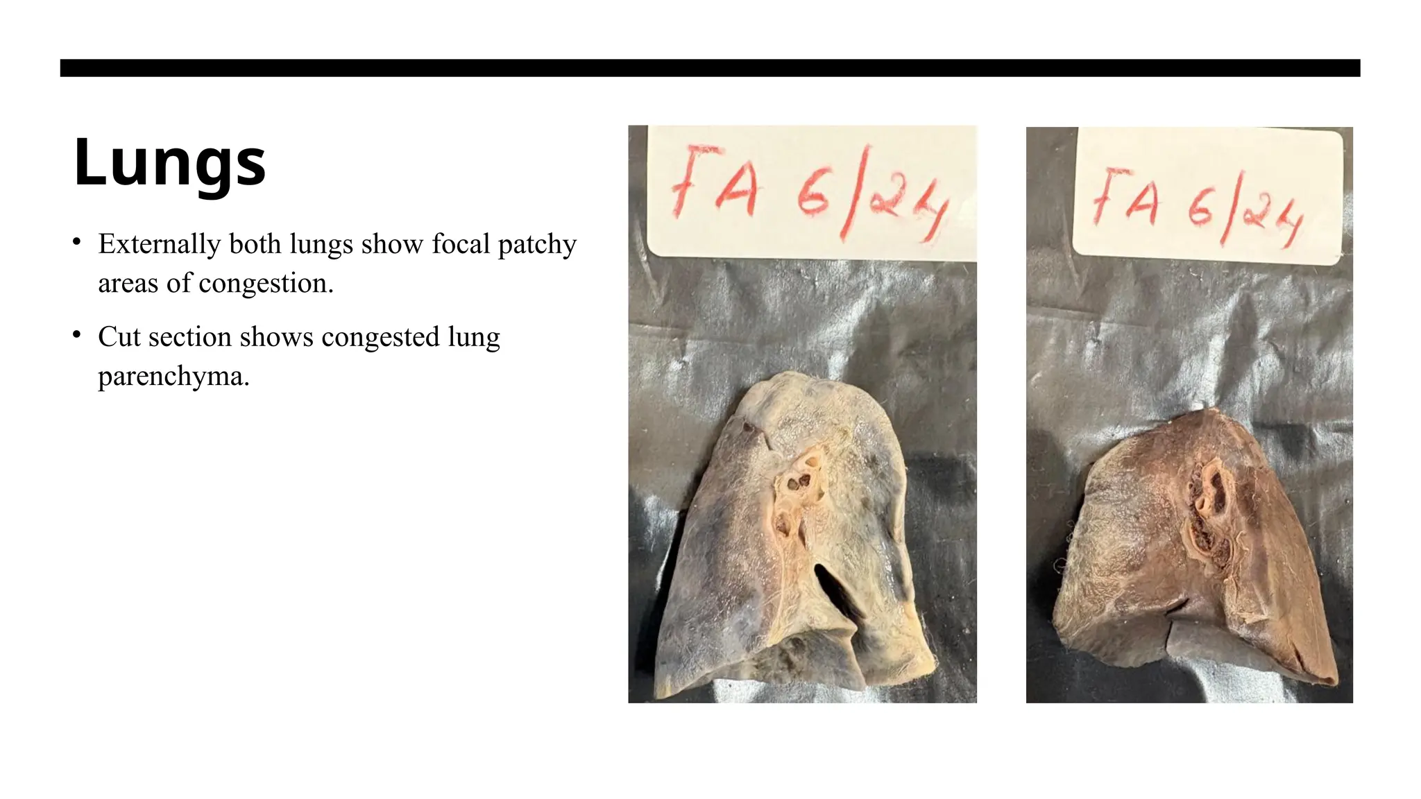 Comprehensive Fetal Autopsy in a Case of Prematurity with Patent Ductus ...