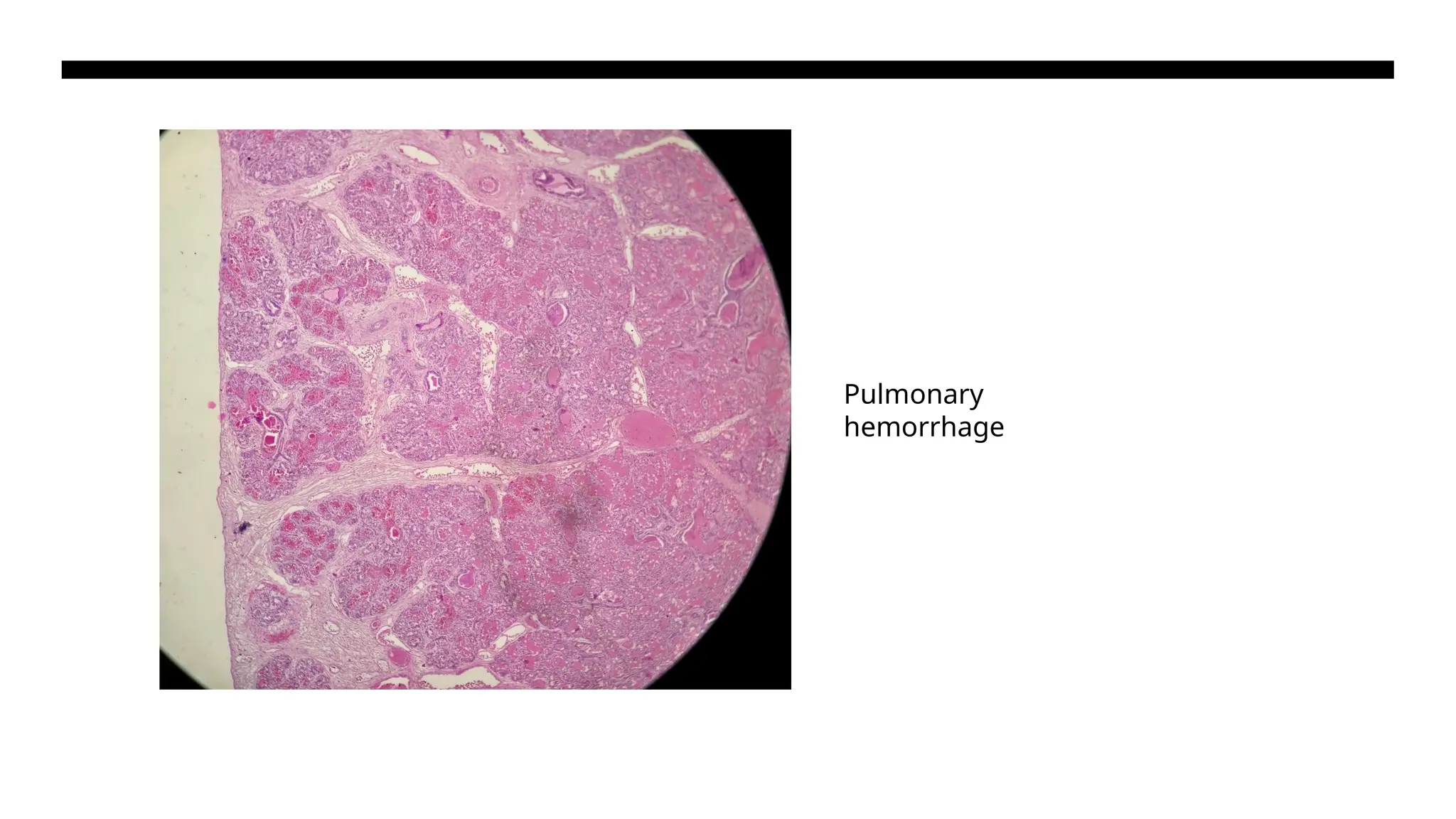 Comprehensive Fetal Autopsy in a Case of Prematurity with Patent Ductus ...