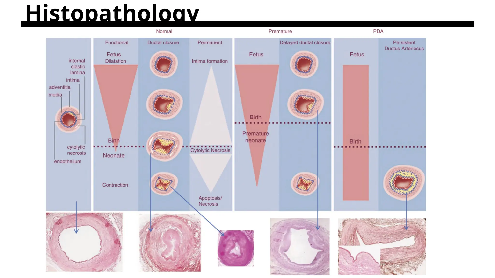 Comprehensive Fetal Autopsy in a Case of Prematurity with Patent Ductus ...