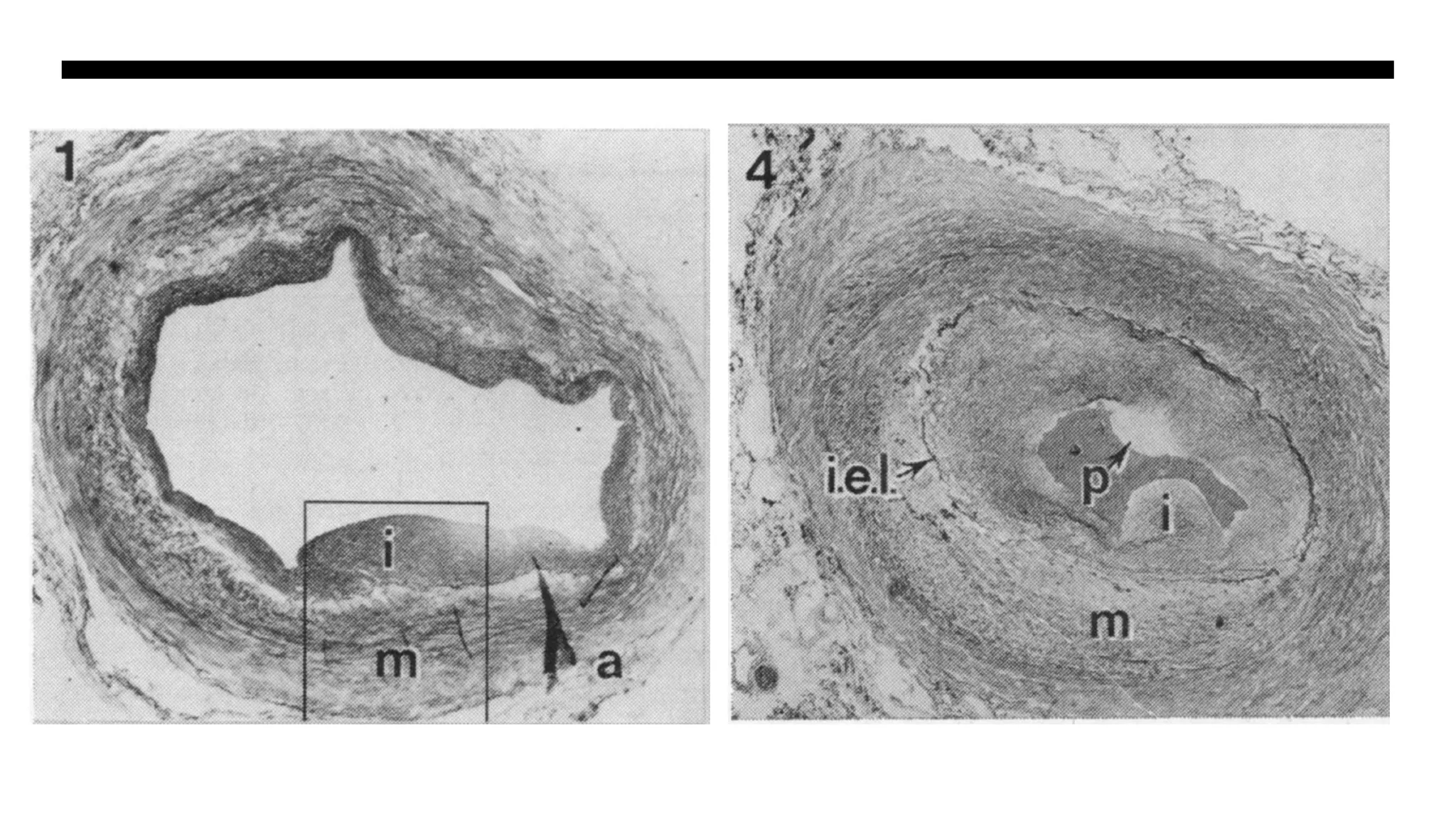 Comprehensive Fetal Autopsy in a Case of Prematurity with Patent Ductus ...