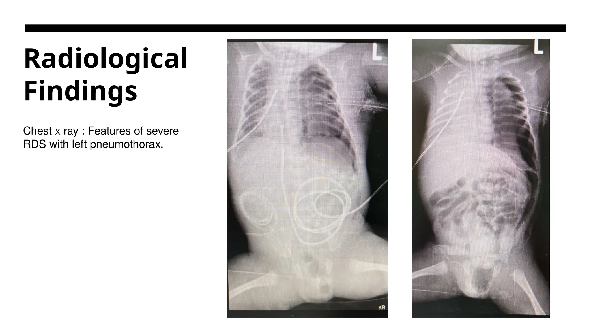 Comprehensive Fetal Autopsy in a Case of Prematurity with Patent Ductus ...