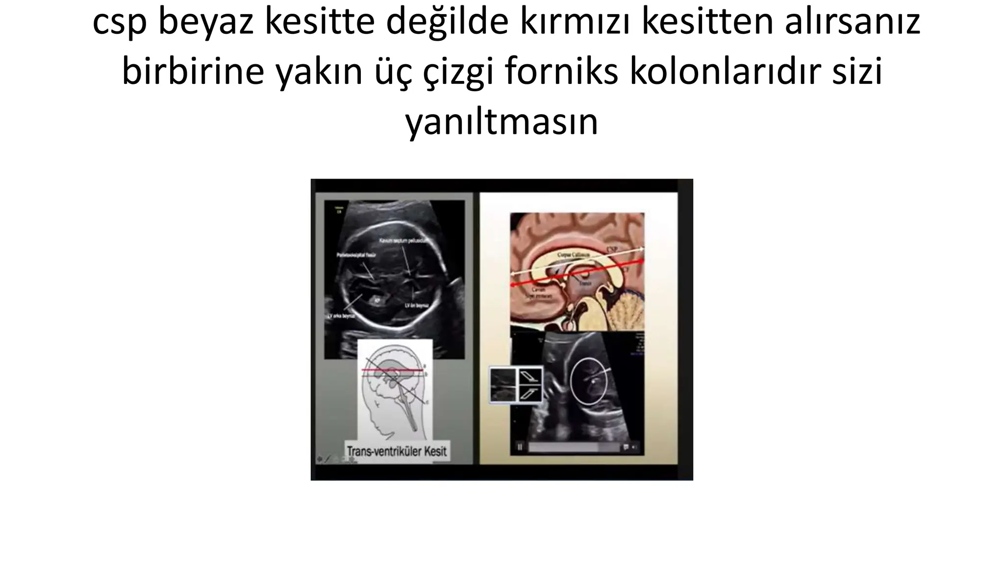 FETAL BEYİN CSP.pptx