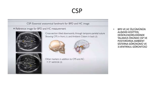 FETAL BEYİN CSP.pptx