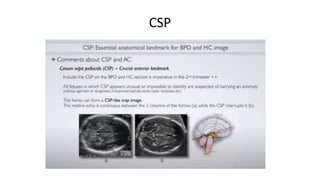 FETAL BEYİN CSP.pptx