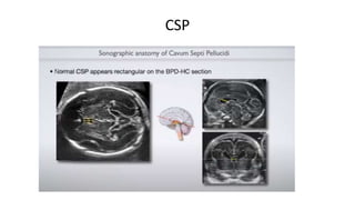 FETAL BEYİN CSP.pptx