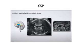 FETAL BEYİN CSP.pptx