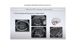 FETAL BEYİN CSP.pptx