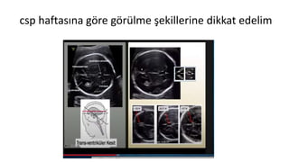 FETAL BEYİN CSP.pptx