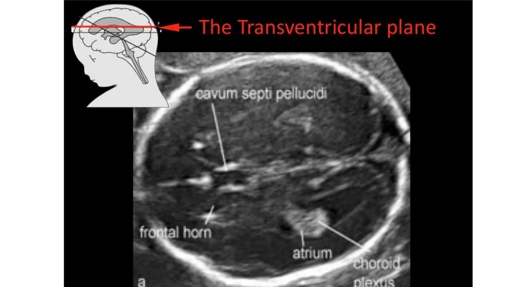 DR.BAHRİ YILDIZ FETAL BEYİN ULTRASONOGRAFİSİ,FETAL BEYİN +CSP+NT ...