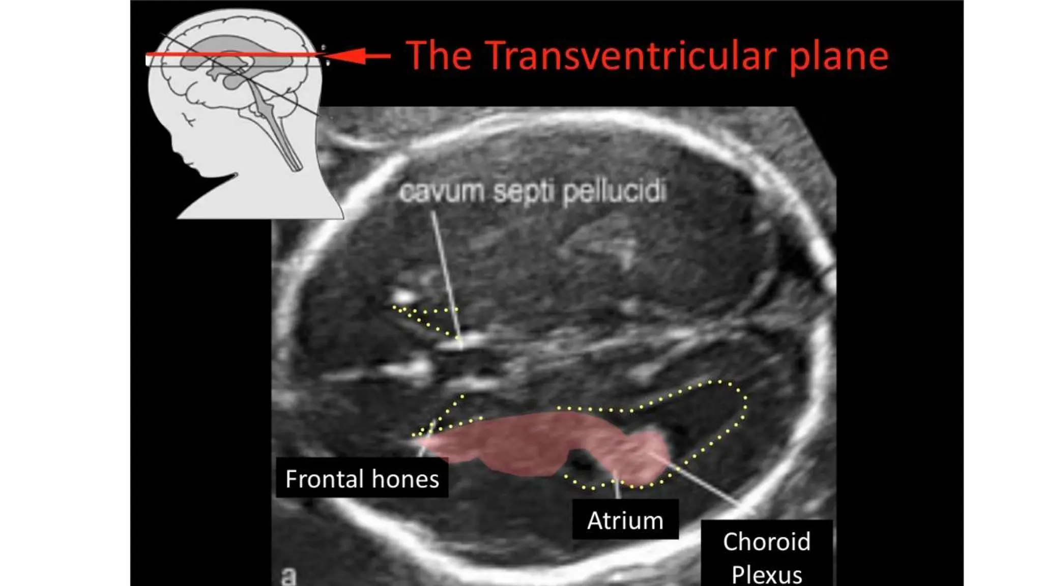 DR.BAHRİ YILDIZ FETAL BEYİN ULTRASONOGRAFİSİ,FETAL BEYİN +CSP+NT ...
