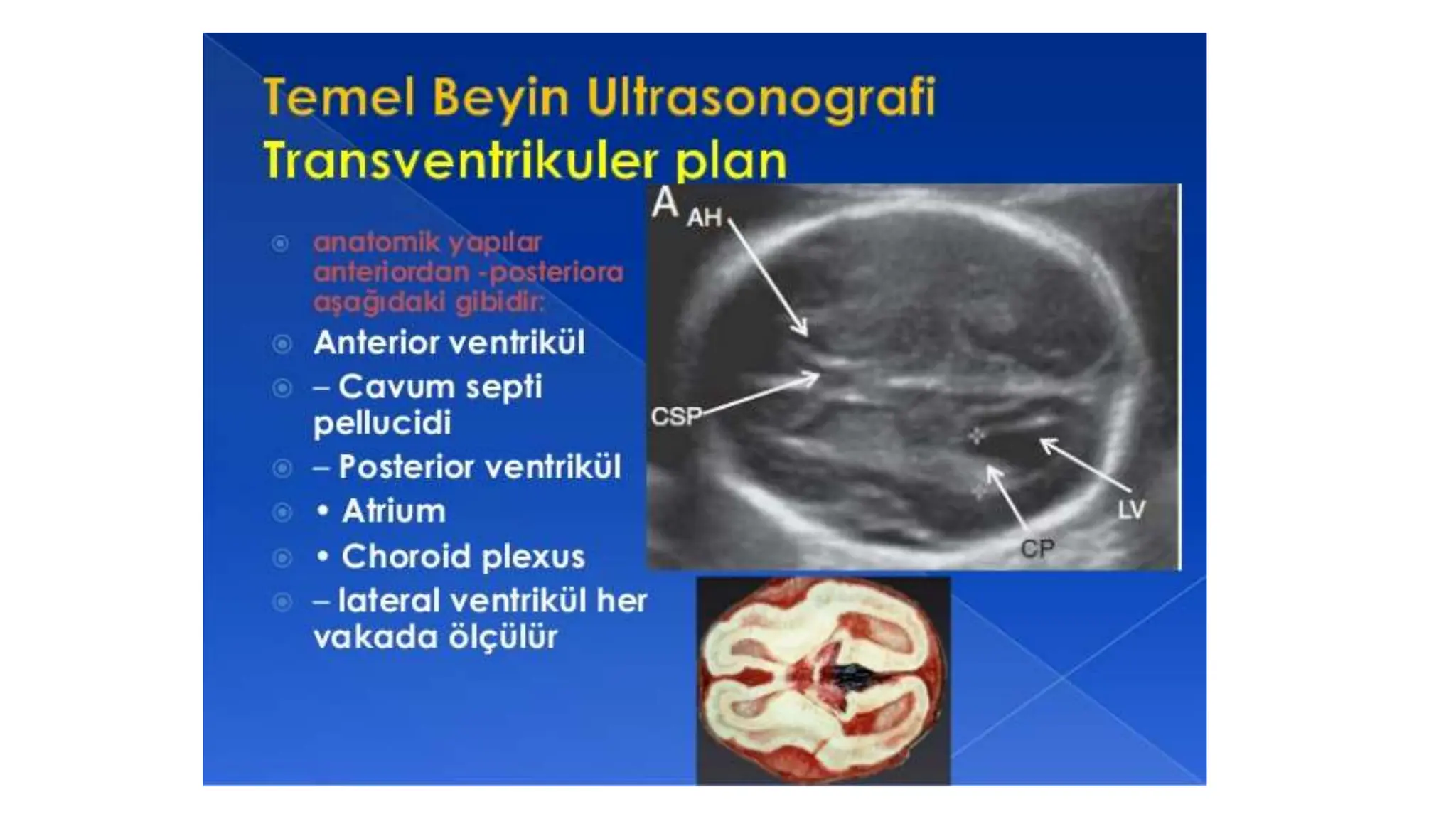 DR.BAHRİ YILDIZ FETAL BEYİN ULTRASONOGRAFİSİ,FETAL BEYİN +CSP+NT ...