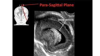 DR.BAHRİ YILDIZ FETAL BEYİN ULTRASONOGRAFİSİ,FETAL BEYİN +CSP+NT ...