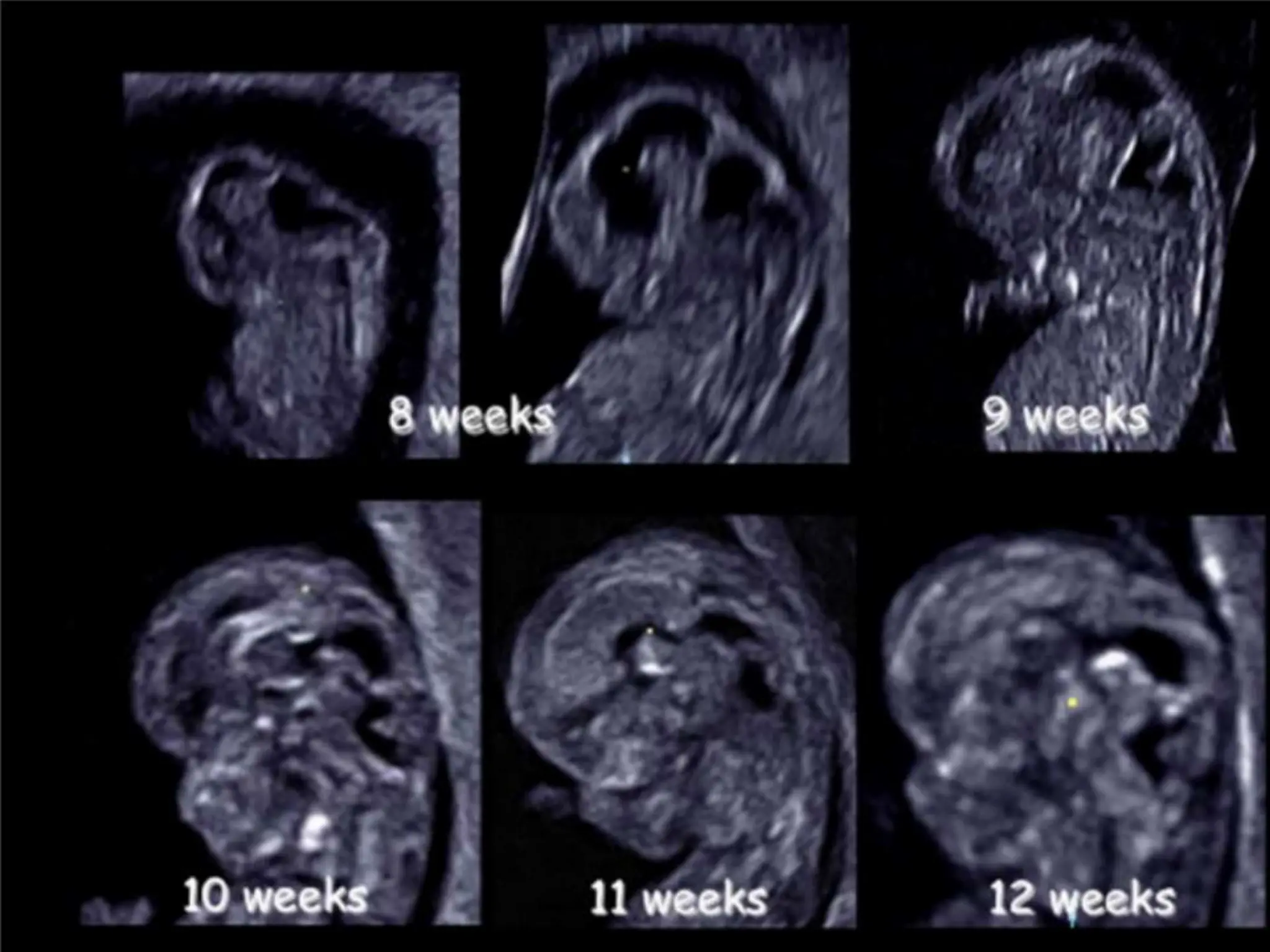 FETAL BEYİN,FETAL NÖROSONOGRAFİ,FETAL NEUROSONOGRAFİ | PPT