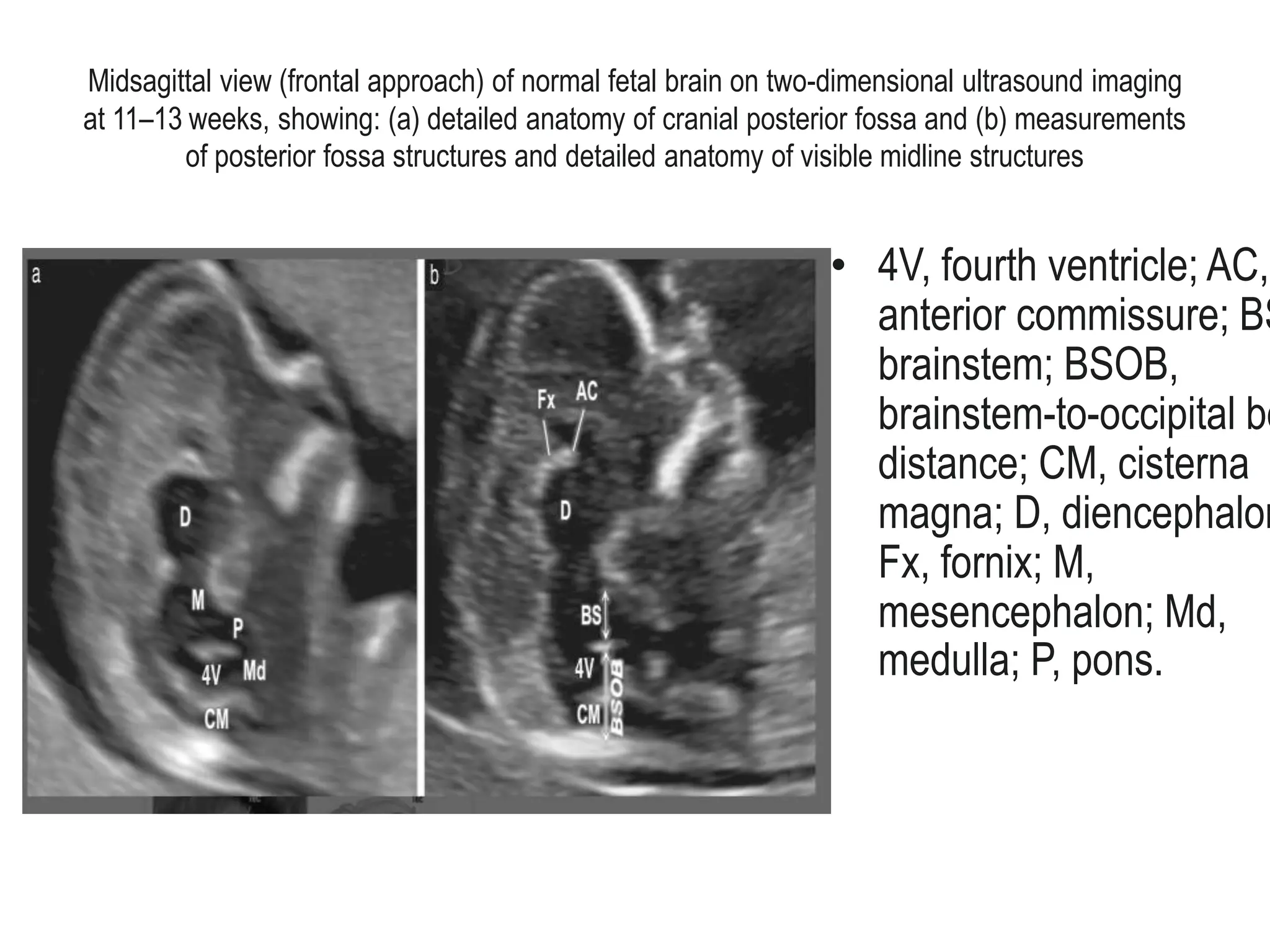 FETAL BEYİN,FETAL NÖROSONOGRAFİ,FETAL NEUROSONOGRAFİ | PPTX