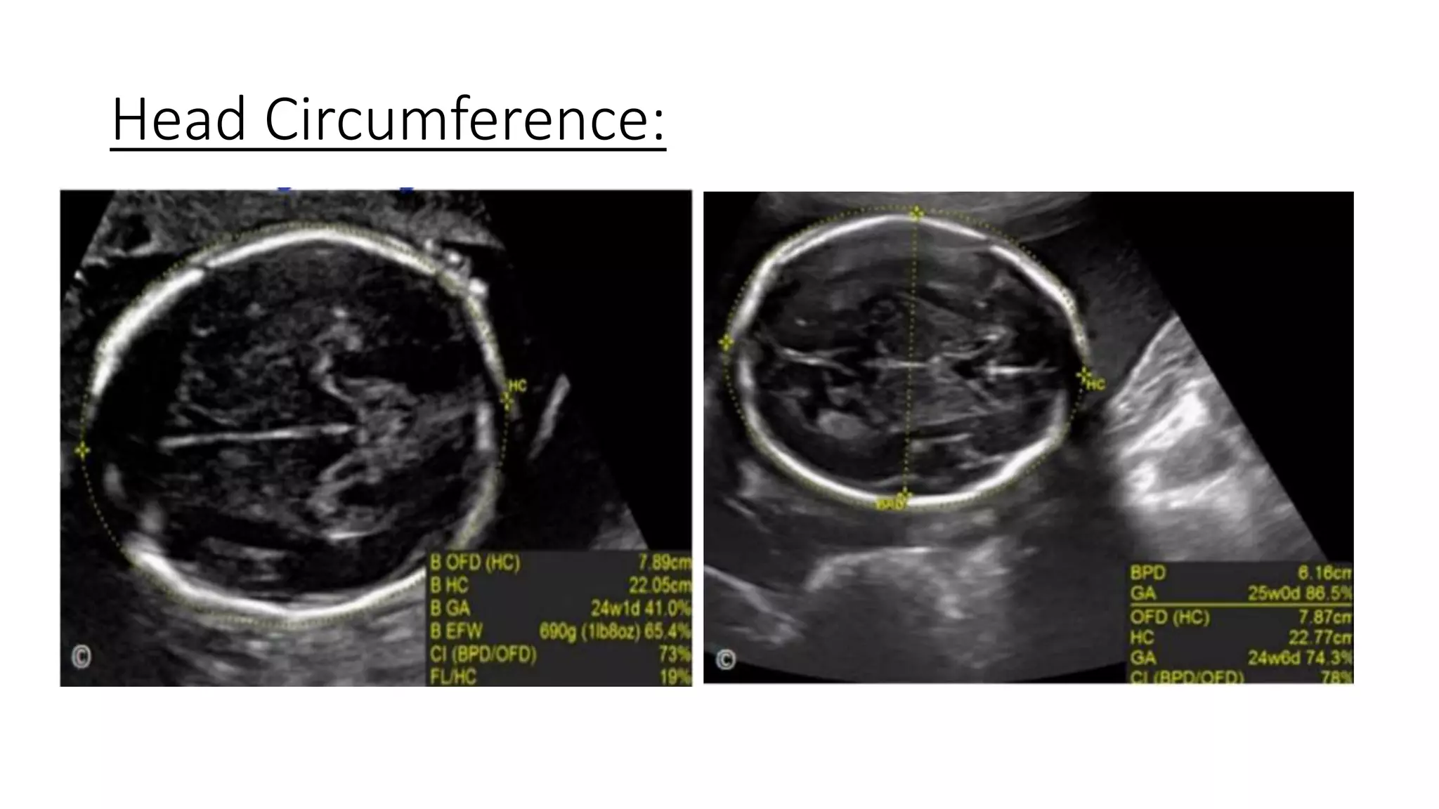 Fetal biometry parameters lk | PPTX