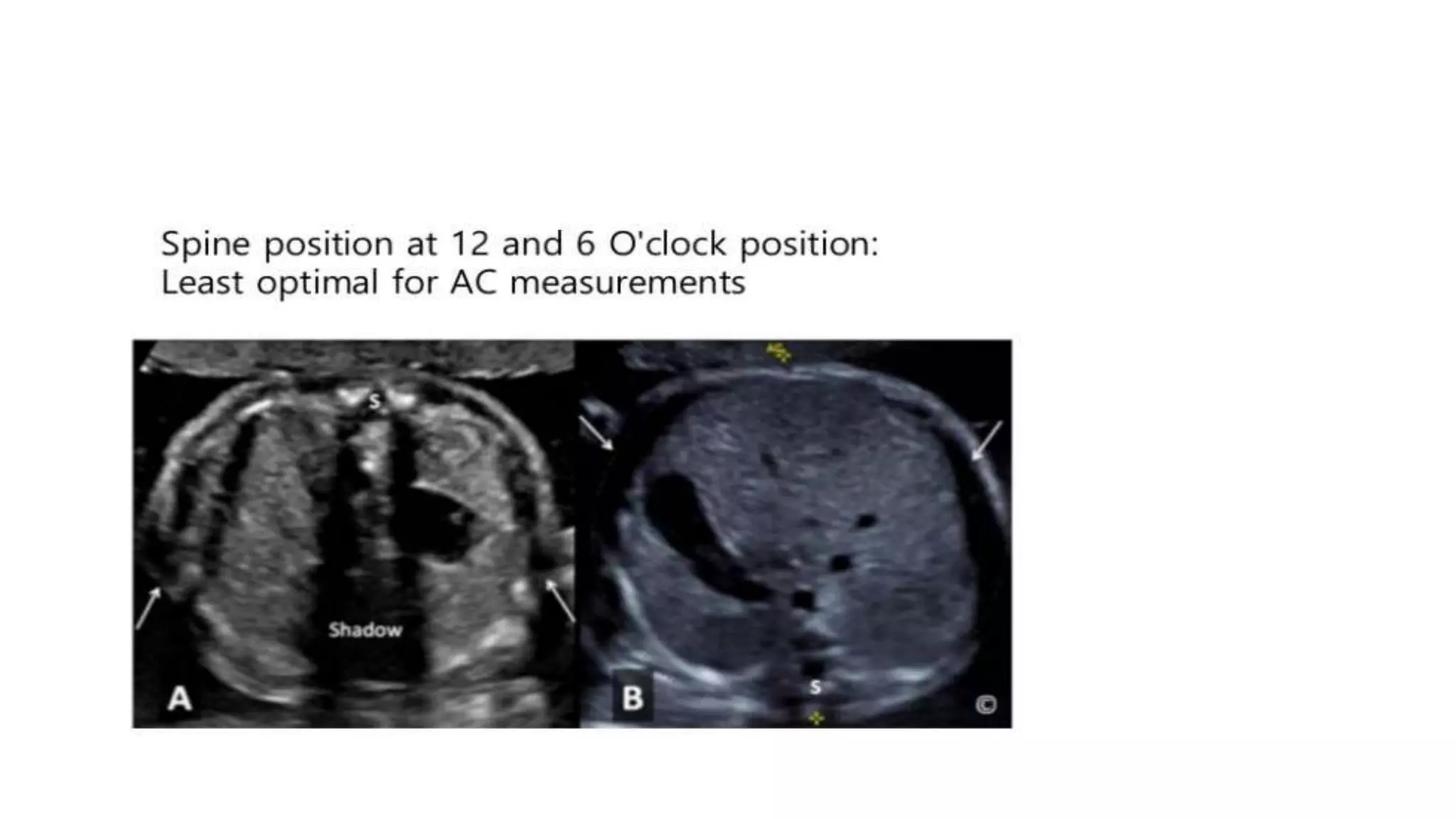 Fetal biometry parameters lk | PPTX