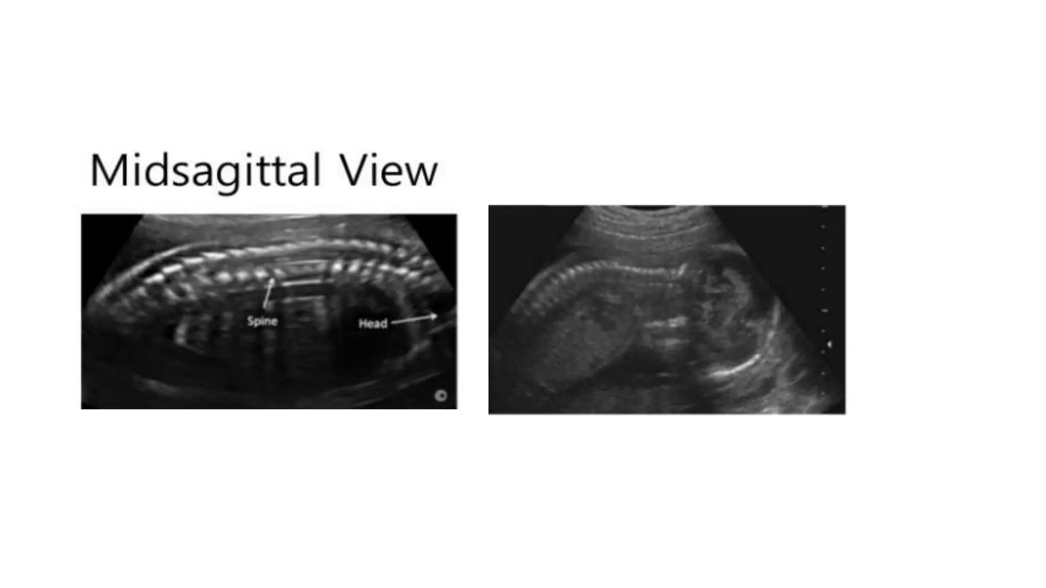 Fetal biometry parameters lk | PPTX