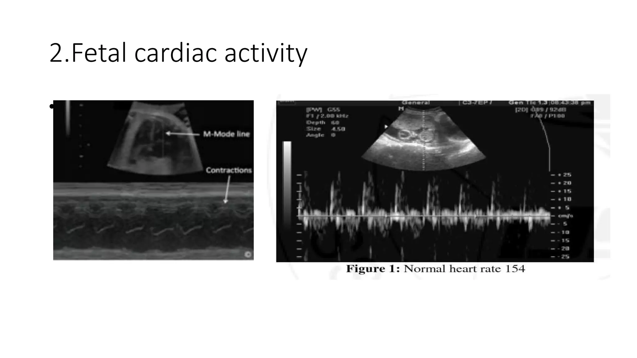 Fetal biometry parameters lk | PPTX