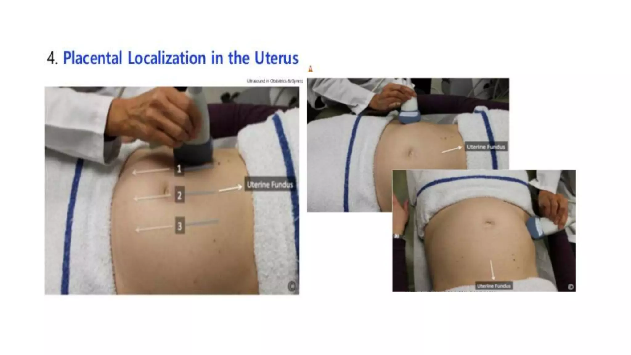 Fetal biometry parameters lk | PPTX