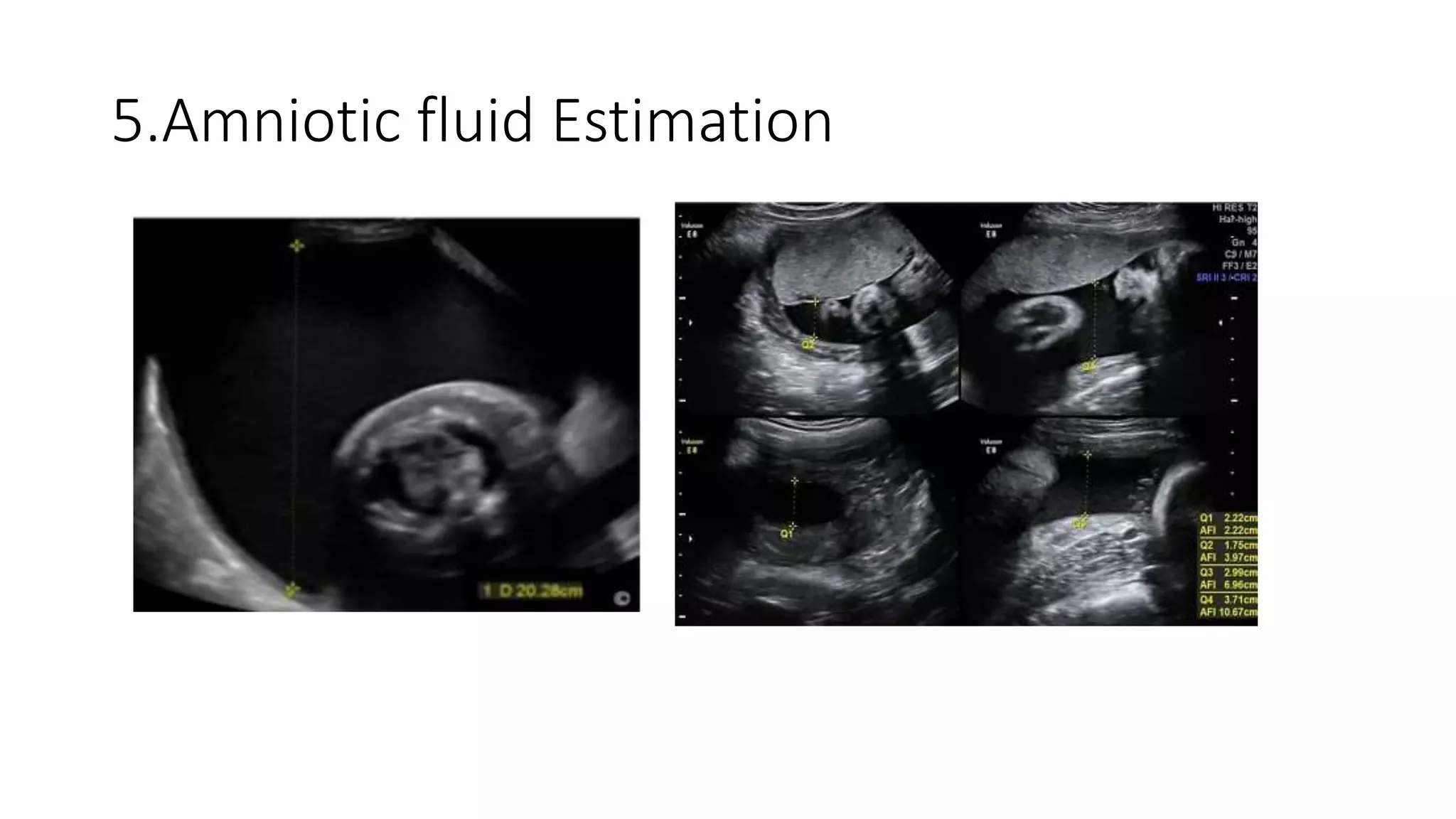 Fetal biometry parameters lk | PPTX