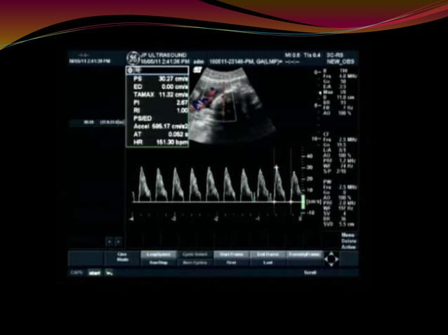Fetal biophysical profile | PPTX