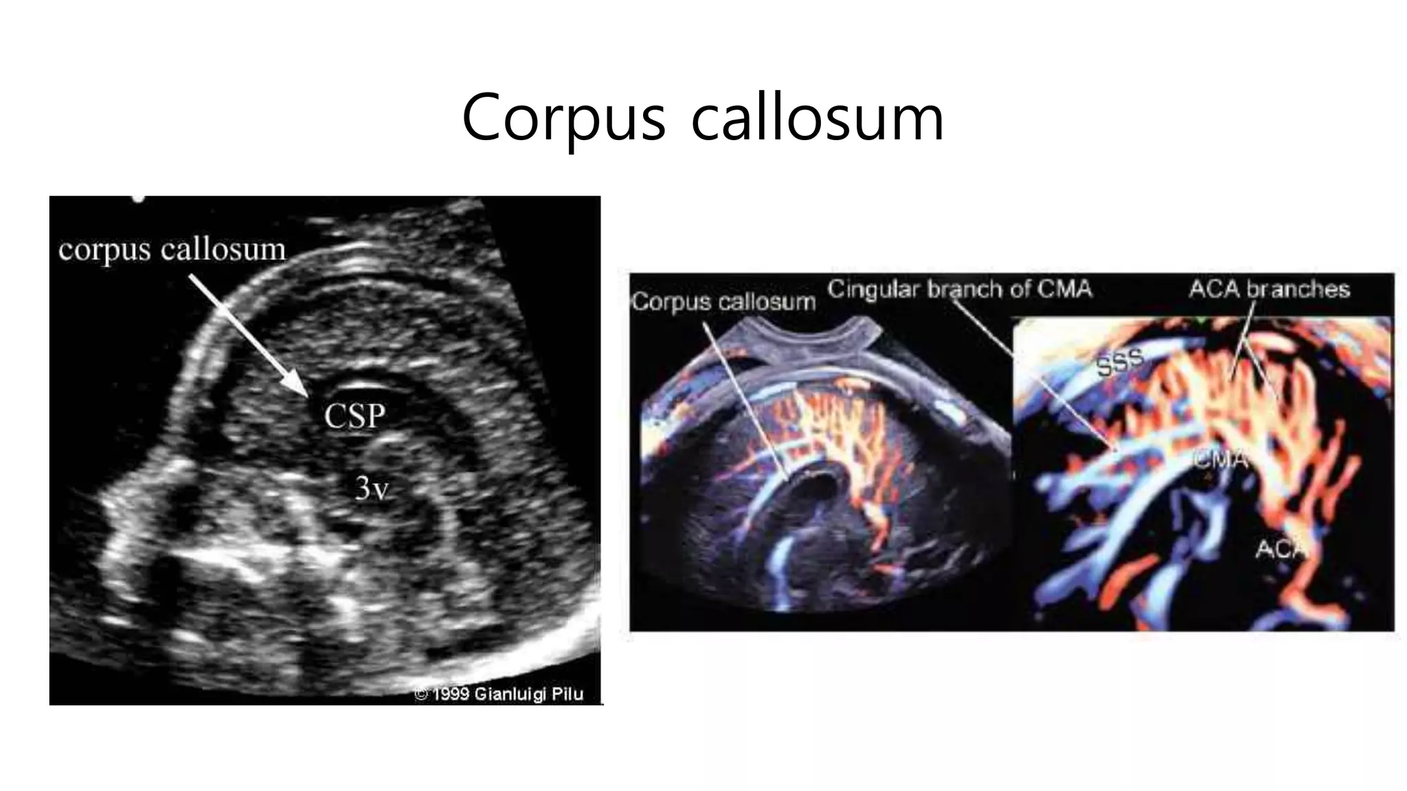 Fetal brain anomalies | PPTX