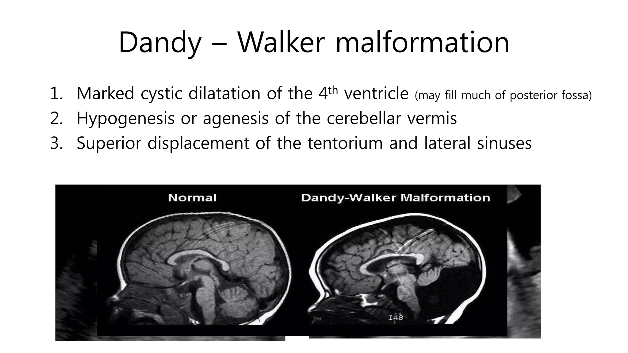 Fetal brain anomalies | PPTX