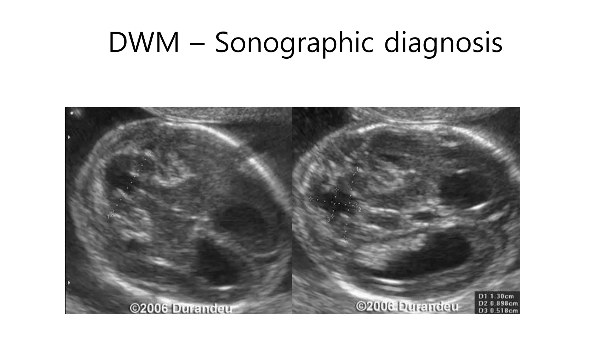 Fetal brain anomalies | PPTX