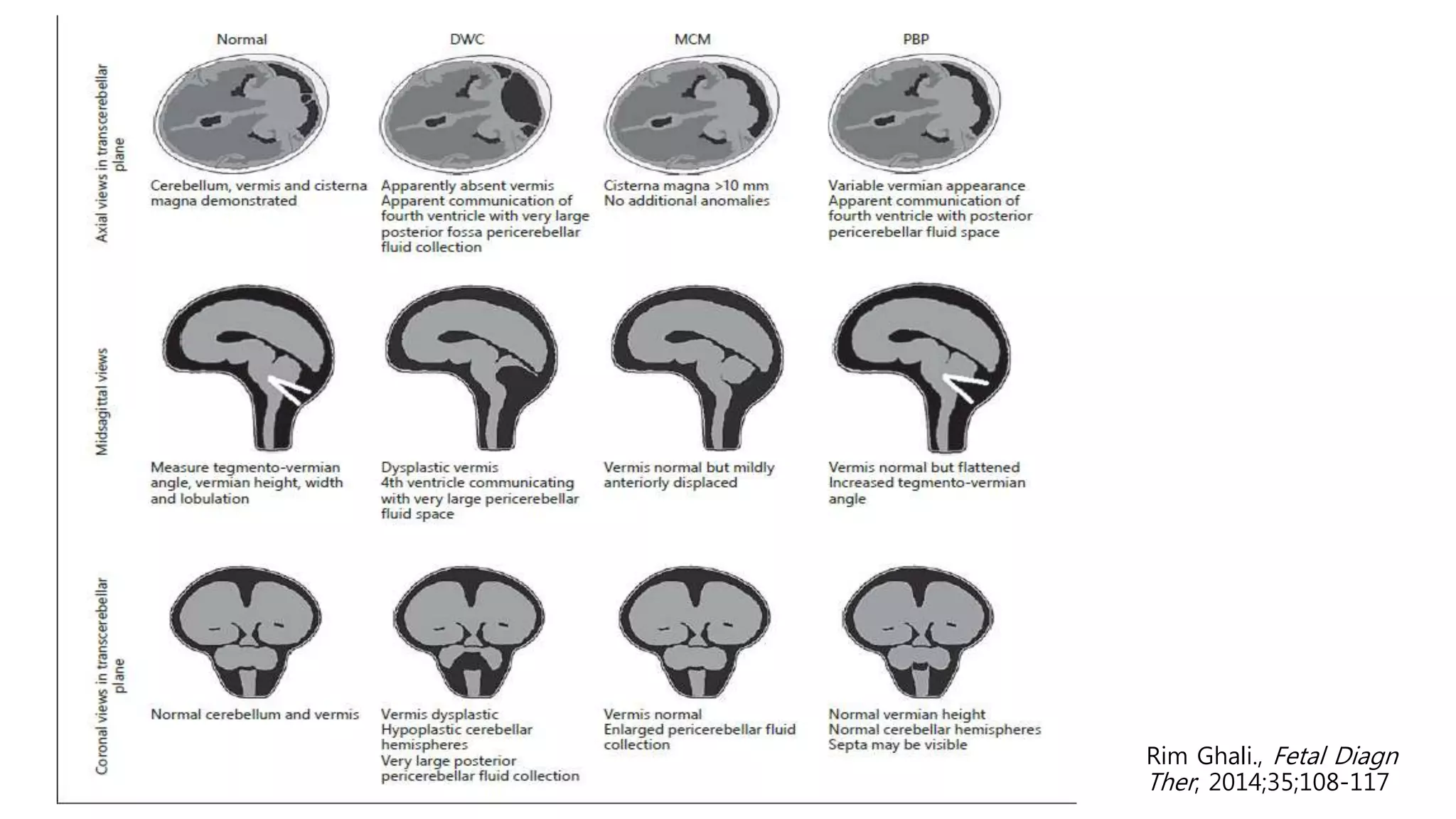 Fetal brain anomalies | PPTX