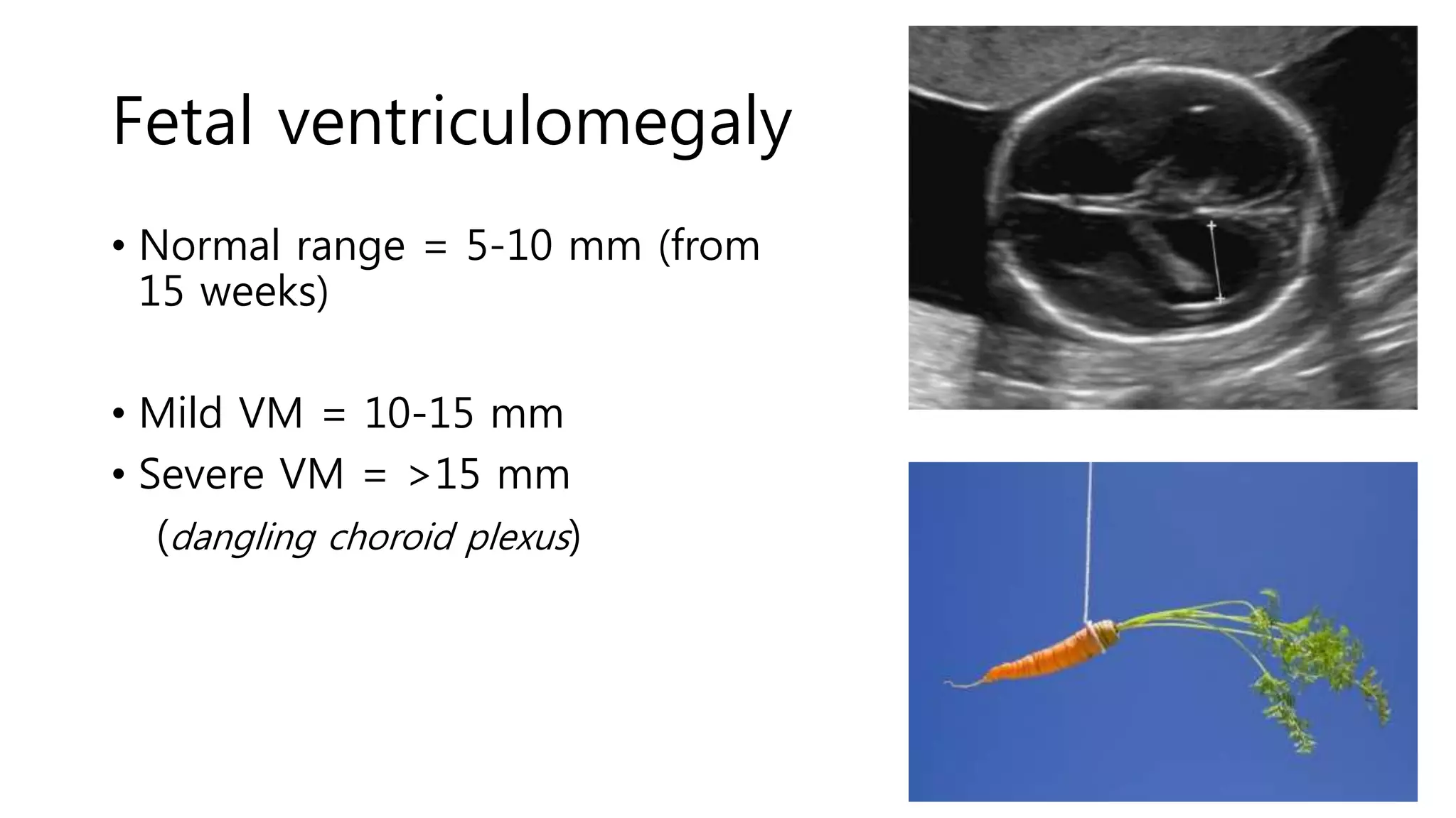 Fetal brain anomalies | PPTX