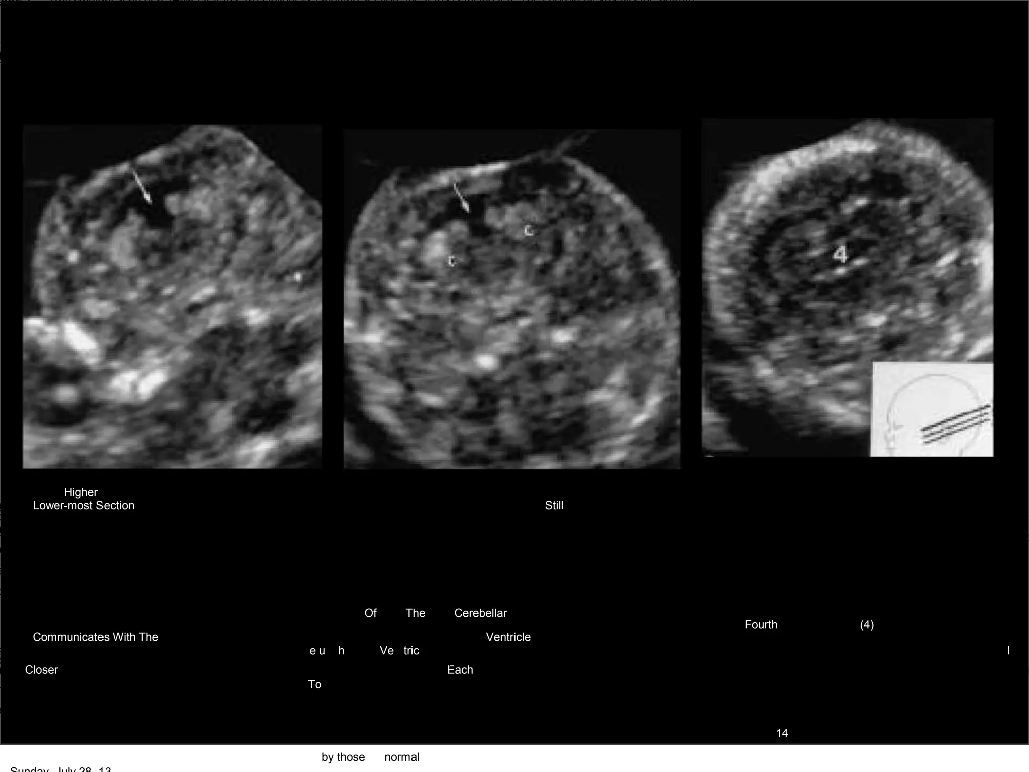 Fetal brain usg 1 | PPTX