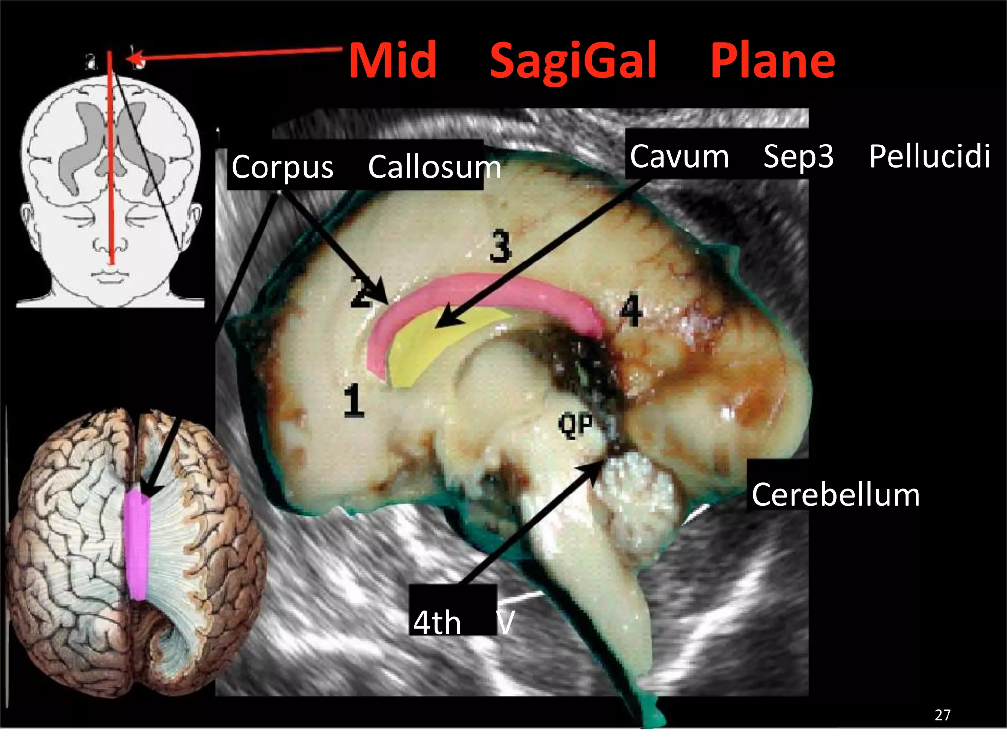 Fetal brain usg 1 | PPTX