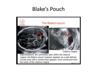 Fetal brain usg 1 | PPT