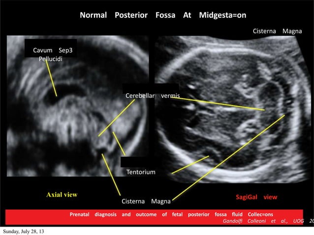 Fetal brain usg 1