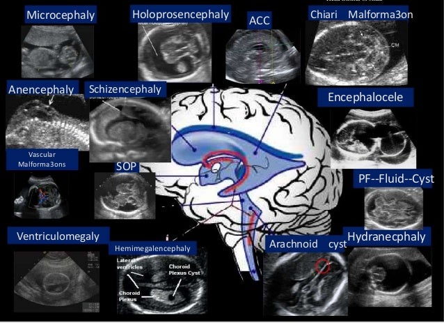 Fetal brain usg 1
