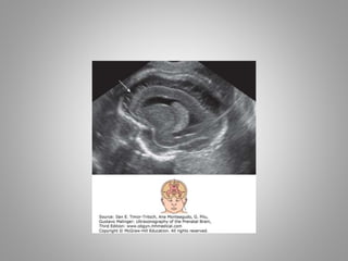 Fetal brain usg 3 | PPTX