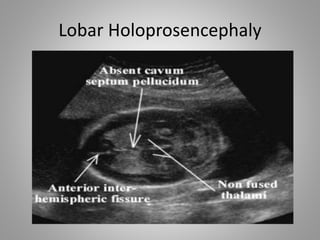 Holoprosencephaly Ultrasound
