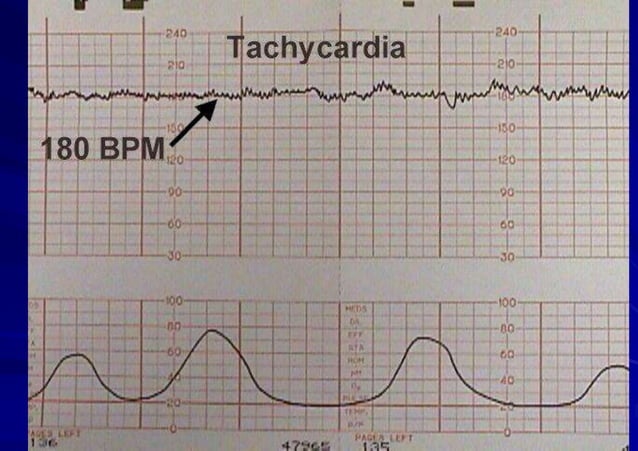 Fetal Cardiotocograph (CTG).pptx | Pregnancy | Reproductive Health