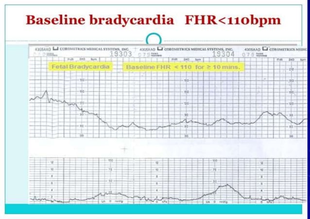 Fetal Cardiotocograph (CTG).pptx | Pregnancy | Reproductive Health