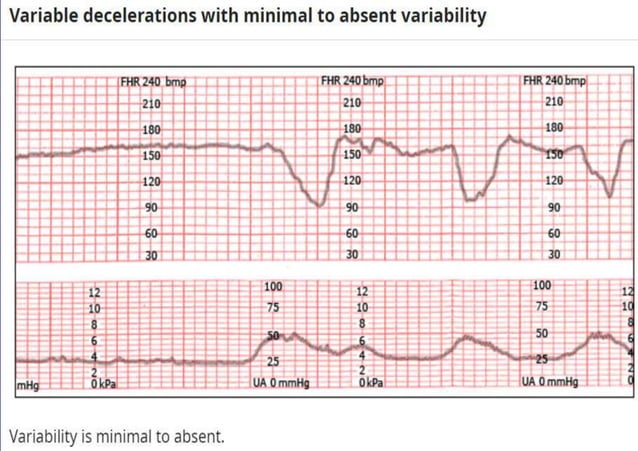 Fetal Cardiotocograph (CTG).pptx | Pregnancy | Reproductive Health