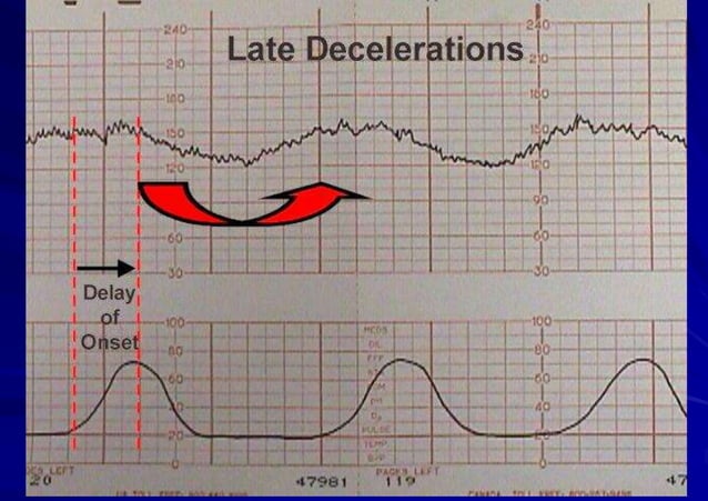 Fetal Cardiotocograph (CTG).pptx | Pregnancy | Reproductive Health