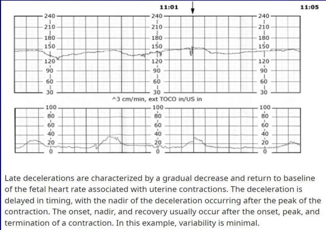 Fetal Cardiotocograph (CTG).pptx | Pregnancy | Reproductive Health