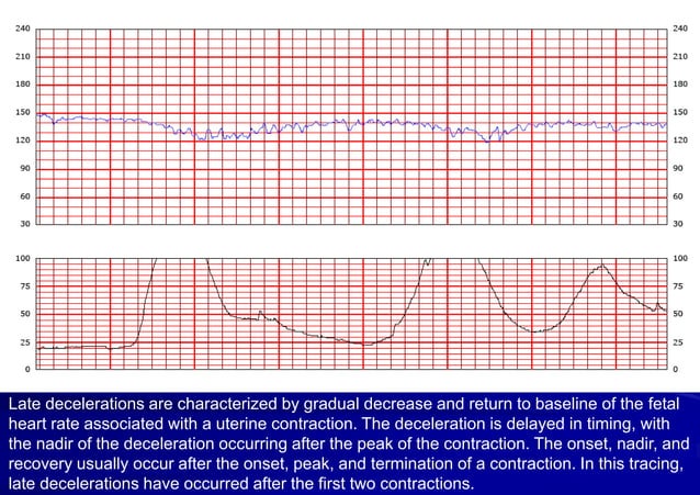 Fetal Cardiotocograph (CTG).pptx | Pregnancy | Reproductive Health