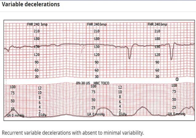 Fetal Cardiotocograph (CTG).pptx | Pregnancy | Reproductive Health
