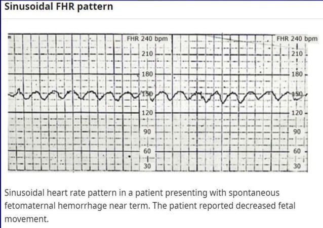Fetal Cardiotocograph (CTG).pptx | Pregnancy | Reproductive Health