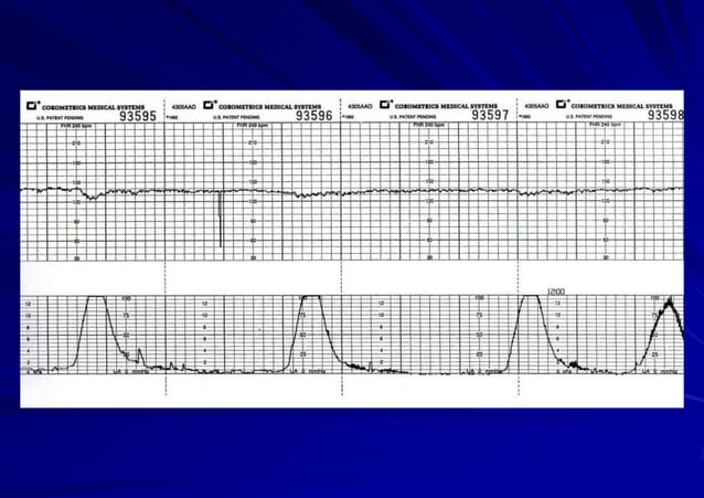Fetal Cardiotocograph (CTG).pptx | Pregnancy | Reproductive Health
