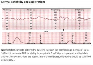 Normal Fetal Heart Tracing