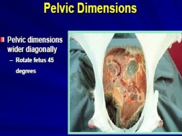 Fetal causes of dystocia | PPT