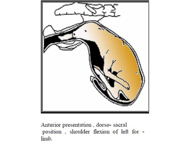 Fetal causes of dystocia | PPT